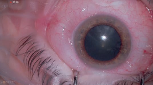 Alcon Ngenuity | Eyetube