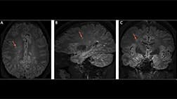The Central Vein Sign in Diagnosis of Multiple Sclerosis - The ...