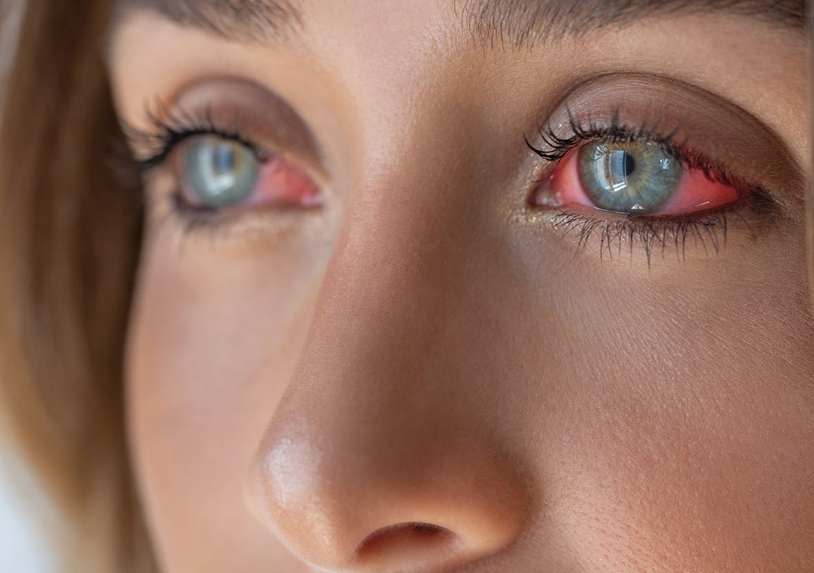 The Role of Inflammation and Immune Response in Dry Eye - Modern Optometry