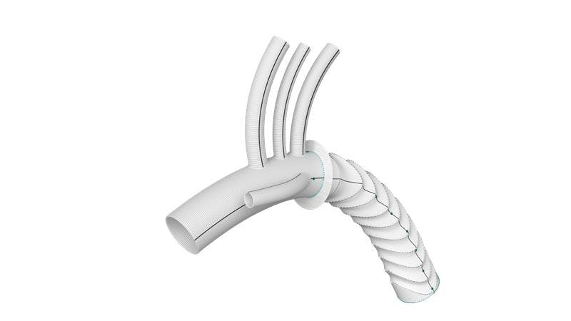 Terumo Aortic’s Thoraflex Hybrid Device for Complex Aortic Arch ...