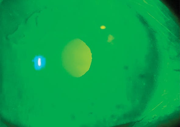Treatment Options for RCE - Modern Optometry