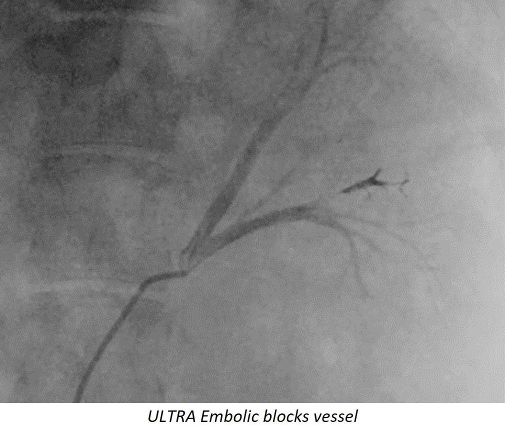 Fluidx Medical’s Ultra Peripheral Embolic Platform in Development ...