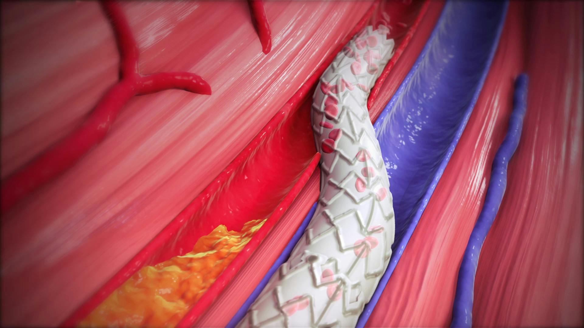 LimFlow System Approved by FDA for Treatment of Patients With No-Option ...