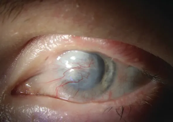 Where Do Specialty Contact Lenses Fit Into The Evolving Medical