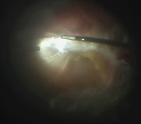 Tips for a Successful Diabetic TRD Surgery - Retina Today