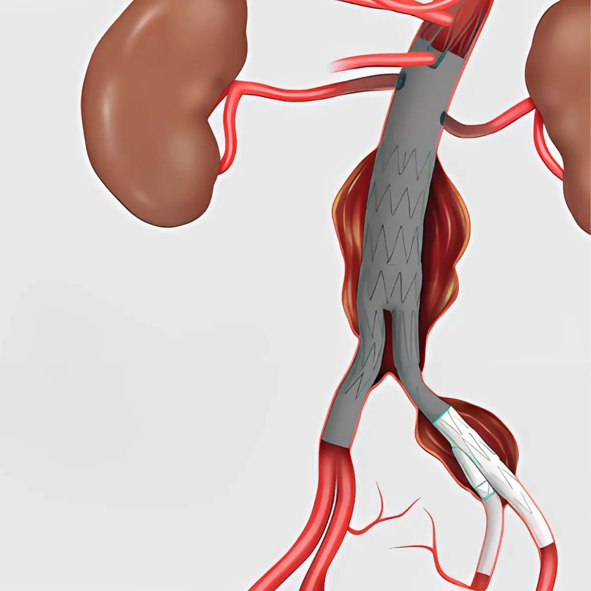 Cook’s Zenith Iliac Branch Device Approved and Launched in United ...