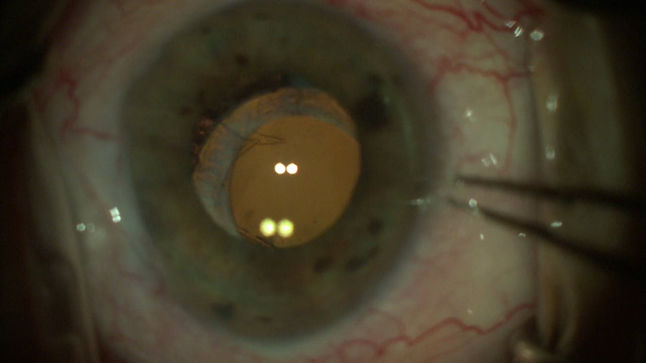 Dislocated Toric IOL in an Eye With a Large, Functioning Bleb After ...