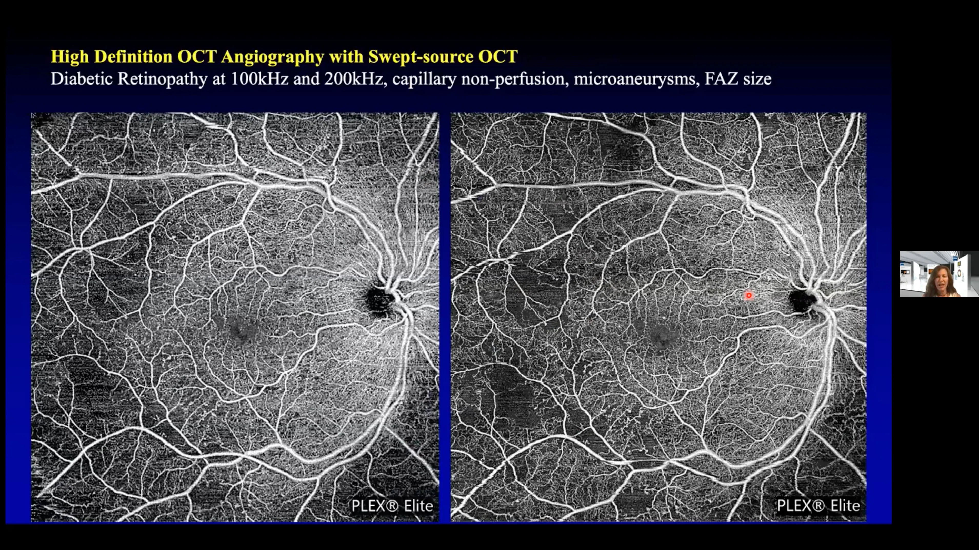OCT-A Imaging to Identify Proliferative Diabetic Retinopathy - Eyetube