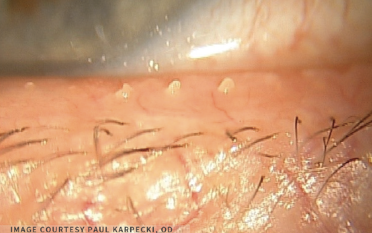 Eyeing Up Evaporation: Getting at the Heart of Dry Eye Disease - Modern ...