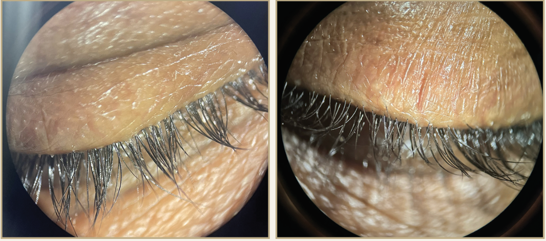 The Demodex Blepharitis Patient Journey With XDEMVY® (lotilaner ...