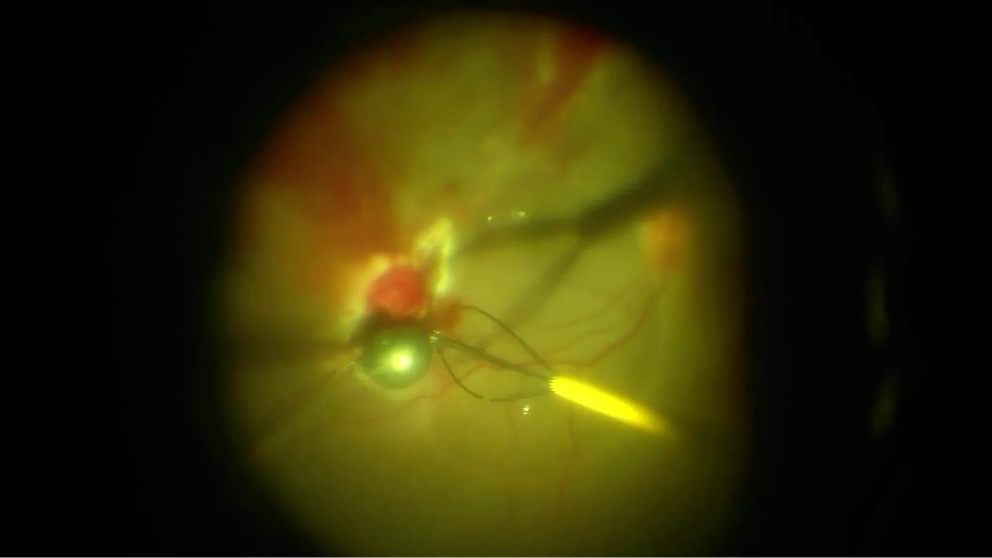 IOFB - Eyetube