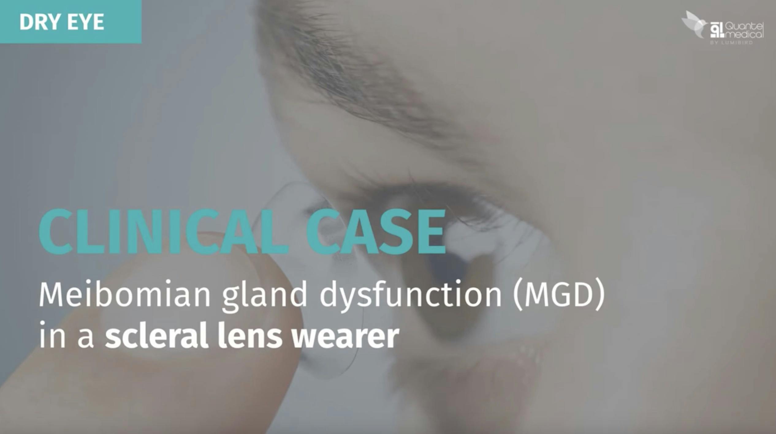 Clinical Case: Meibomian Gland Dysfunction (MGD) in a Scleral Lens ...