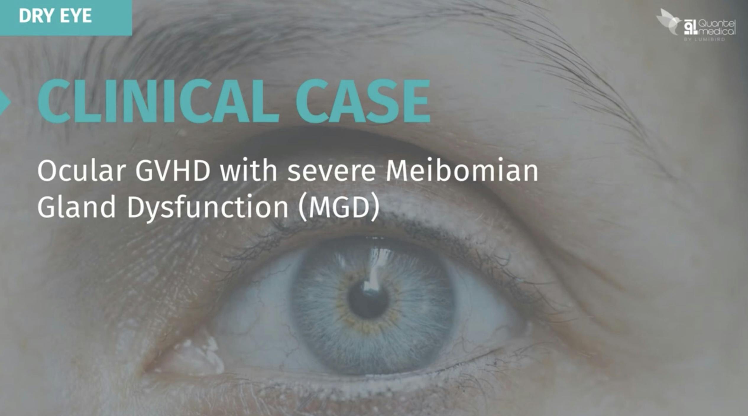 Clinical Case: Ocular GVHD with Severe Meibomian Gland Dysfunction (MGD ...