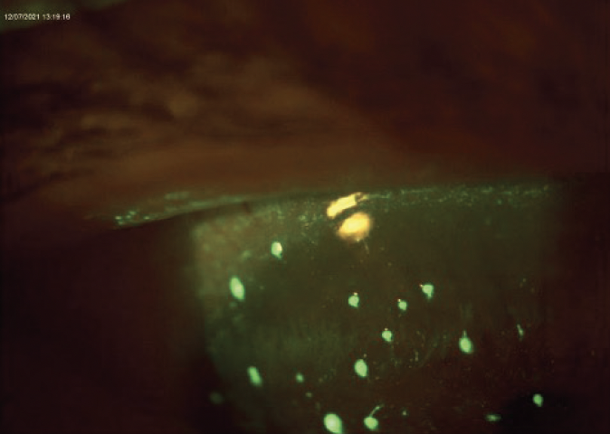 Sjögren Syndrome: Ocular Manifestations of an Underlying Systemic ...