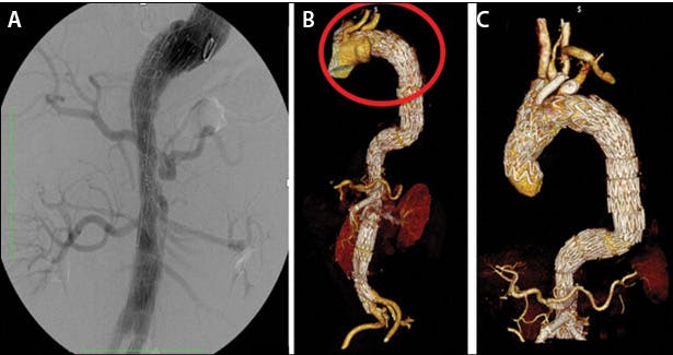 Modern Complex Stent Graft Designs: A Closer Look - Endovascular Today