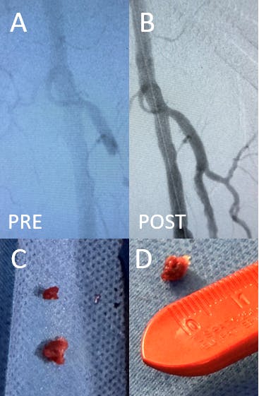 The Artix™ Thrombectomy System: A Safe, Efficient, and Versatile All-in ...