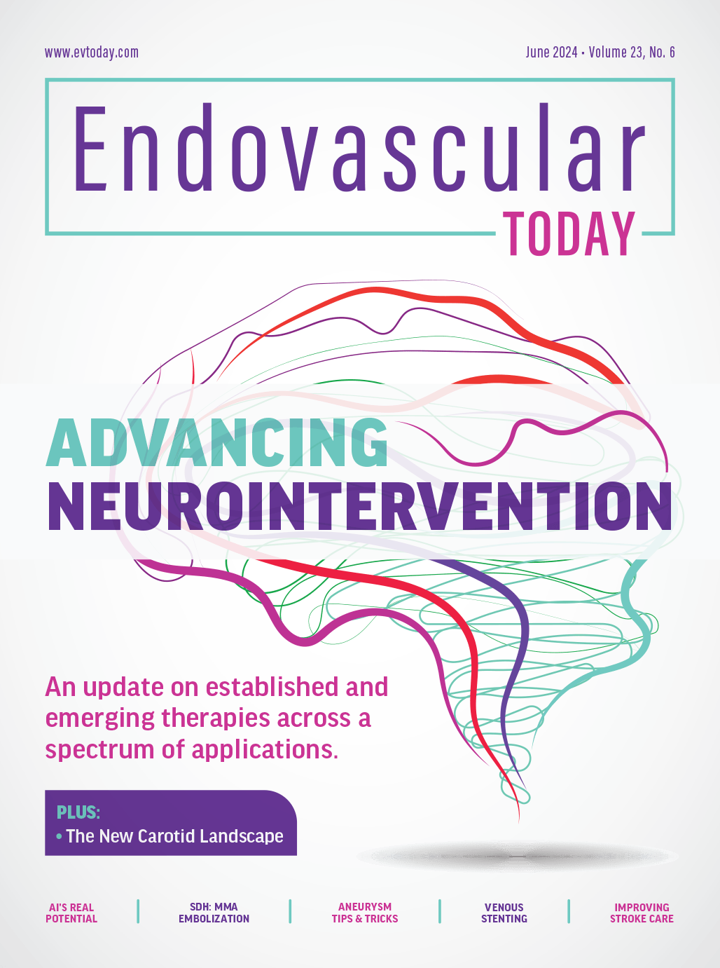 Venous Sinus Stenting for Idiopathic Intracranial Hypertension ...