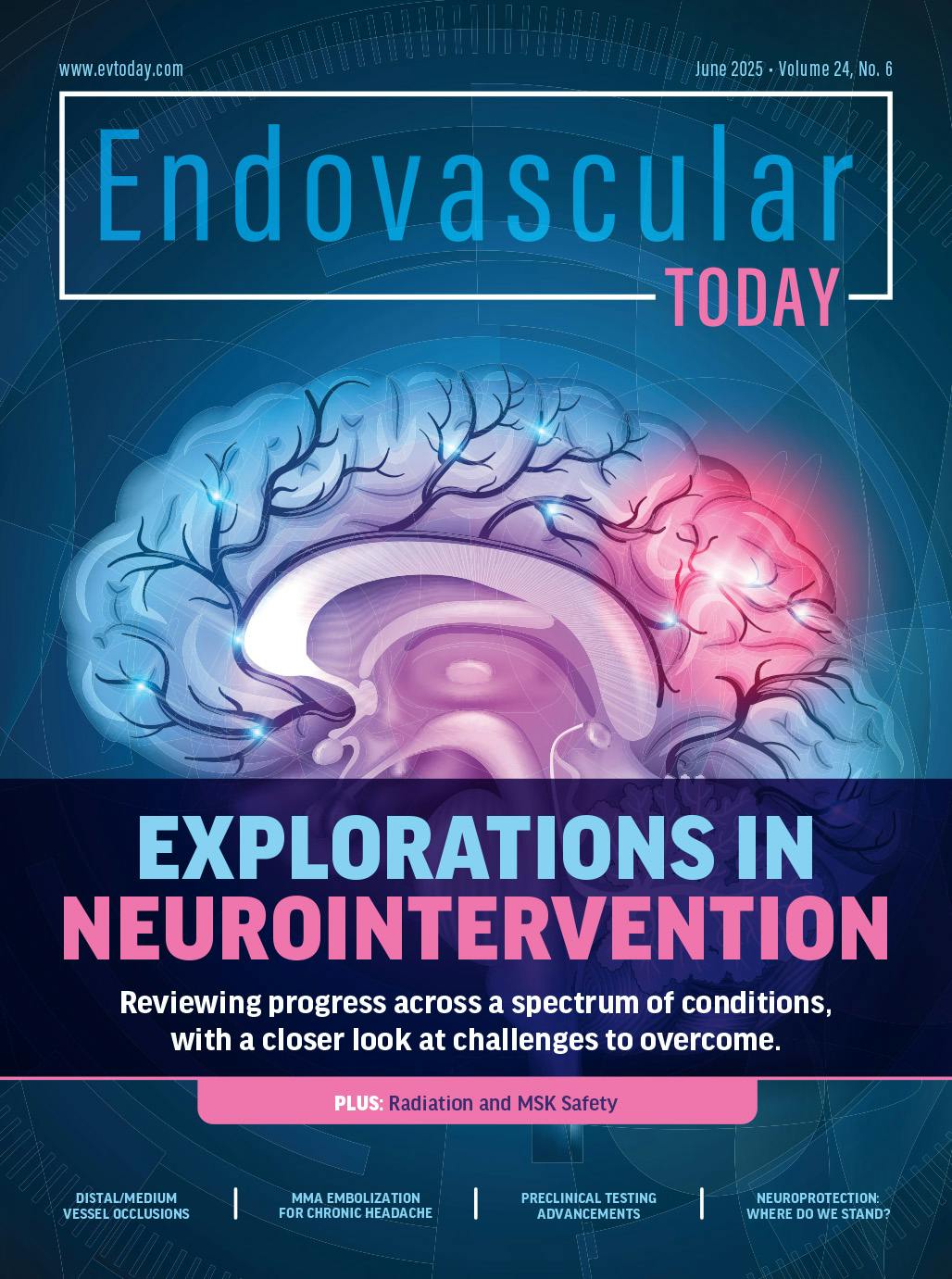 Koya Medical Dayspring Compression Device Evaluated in TEAYS Study for ...