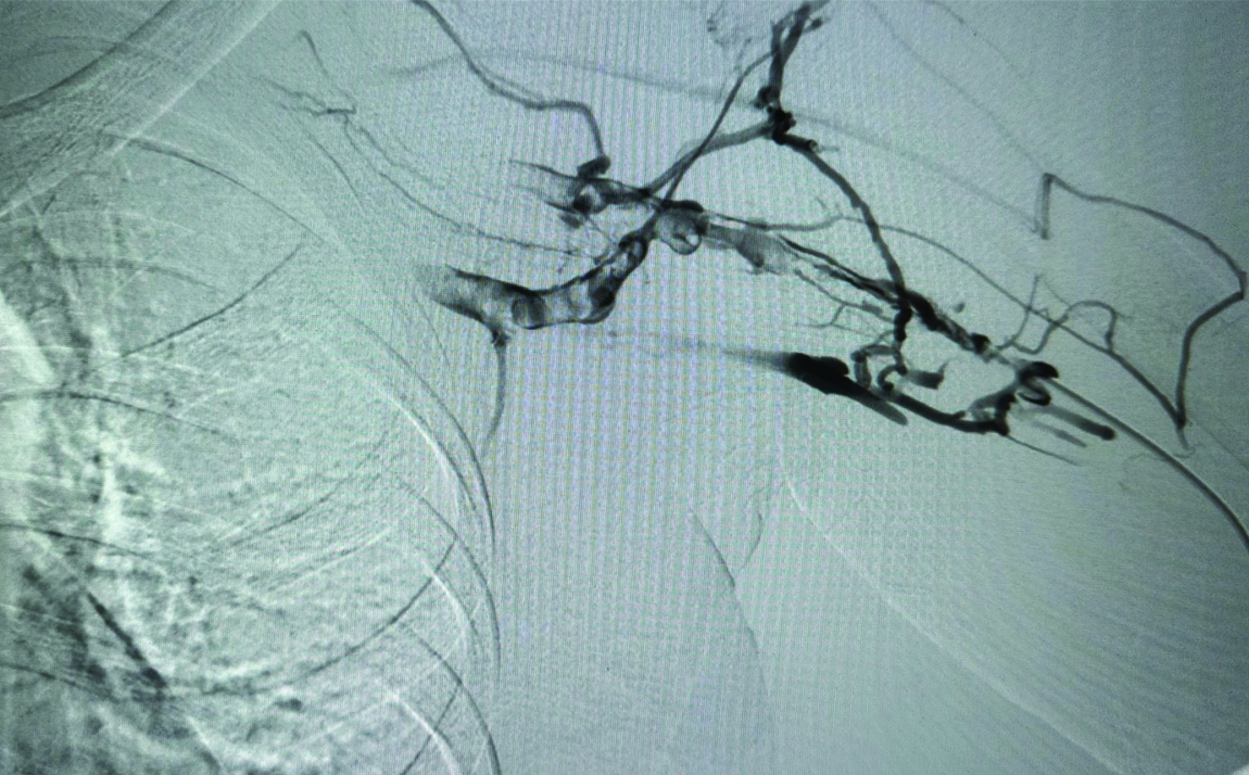Tackling Venous Thrombus With Dual-Action Thrombectomy - Endovascular Today
