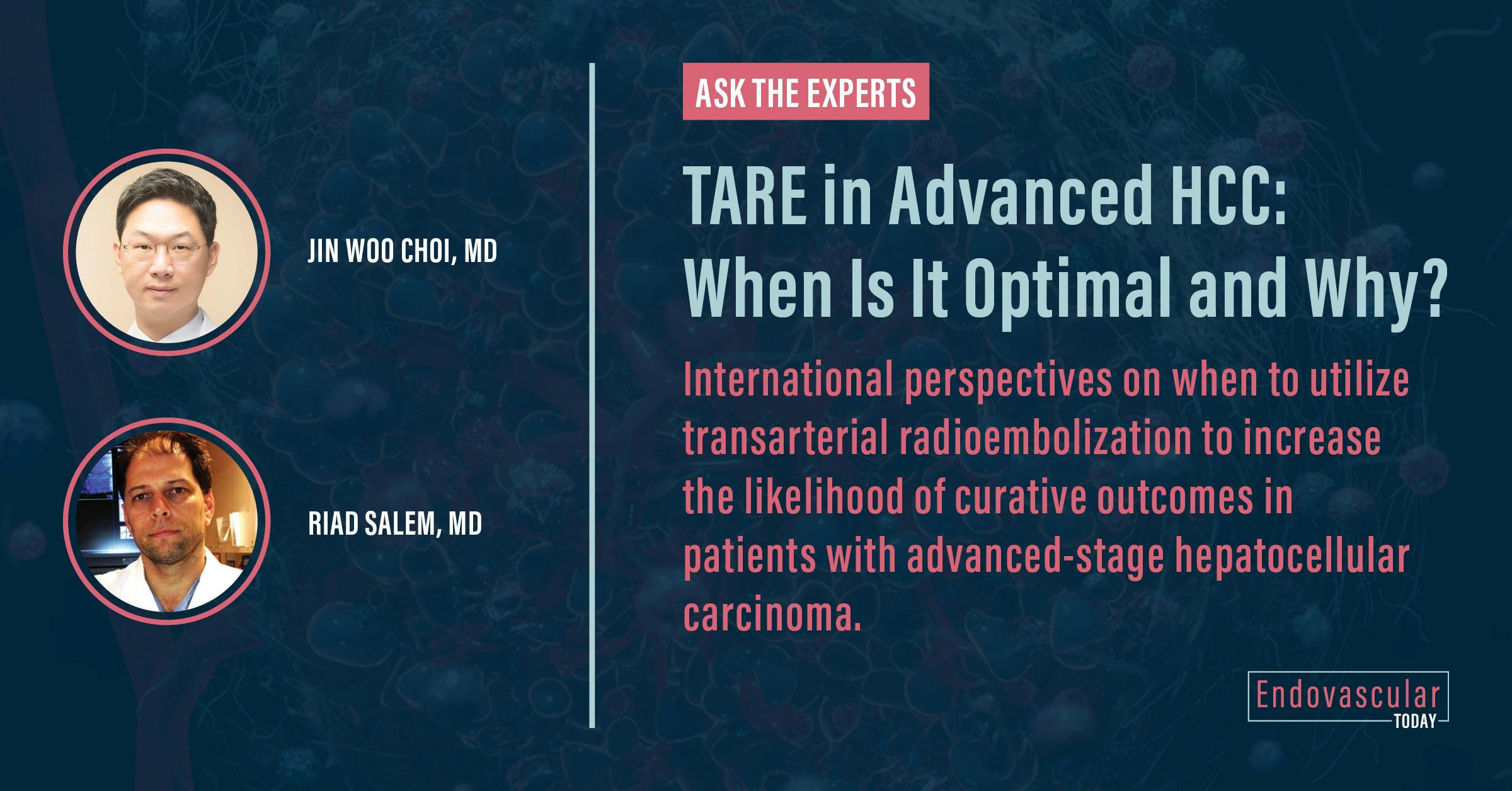 TARE in Advanced HCC: When Is It Optimal and Why? - Endovascular Today