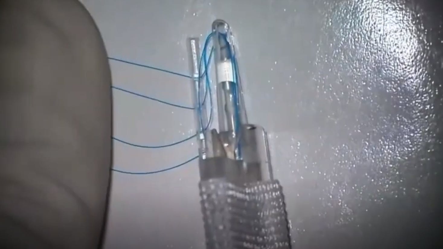 IOL Scleral Fixation With No Intraocular Maneuvers - Eyetube