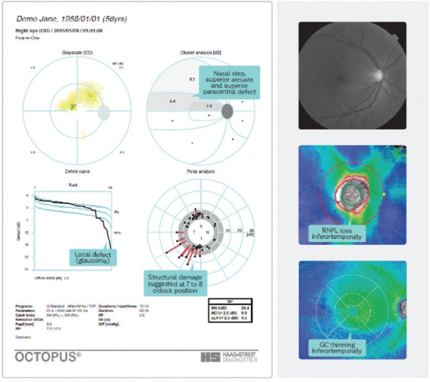 Structure and Function in Early Glaucoma Diagnosis - Modern Optometry