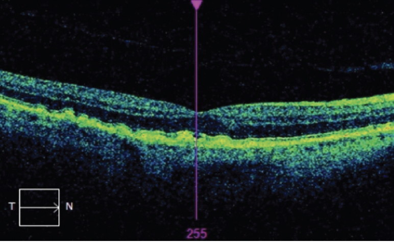 Intermediate AMD Identified: Now What? - Modern Optometry