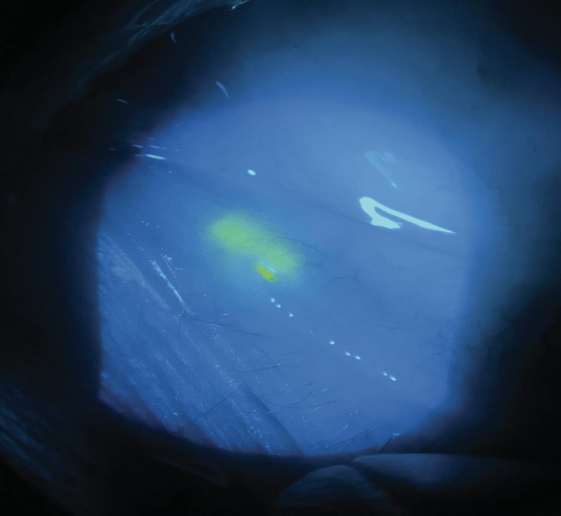 Focus on the Cataract Patient’s Experience - Modern Optometry