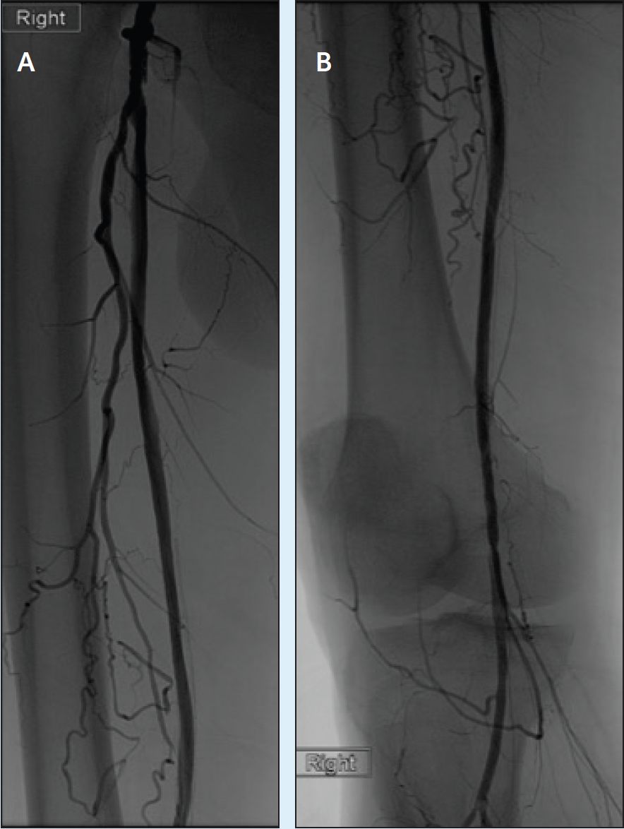 Long Balloons in Practice: Improving Our Treatment Options ...