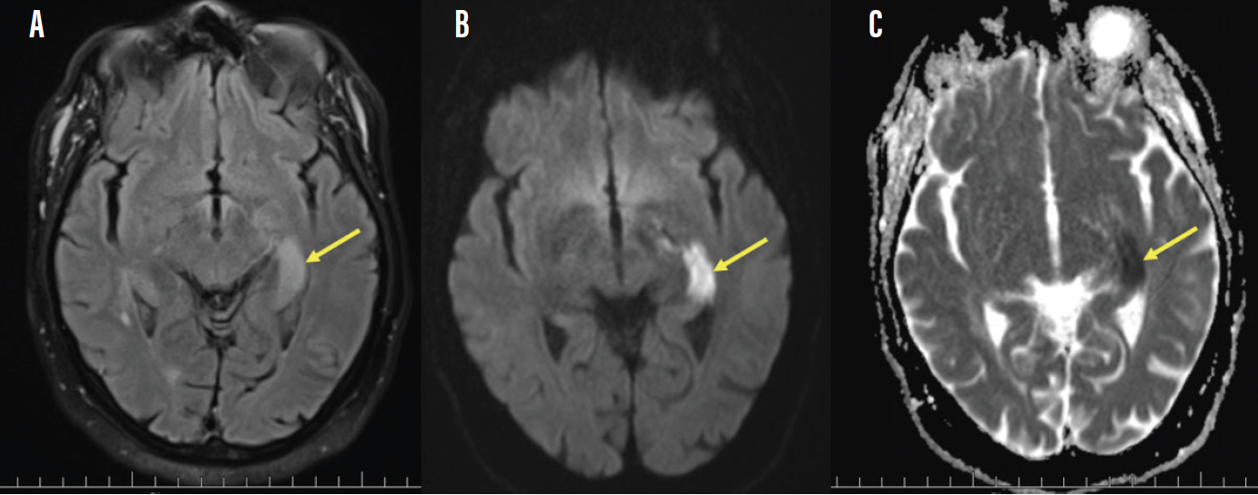 A Case of Multiple Visual Field Defects Secondary to Glaucoma - Modern ...