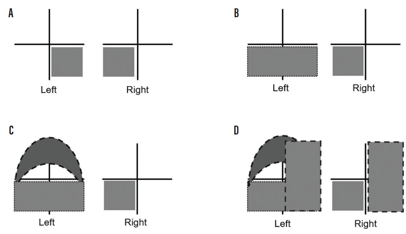 A Case of Multiple Visual Field Defects Secondary to Glaucoma - Modern ...
