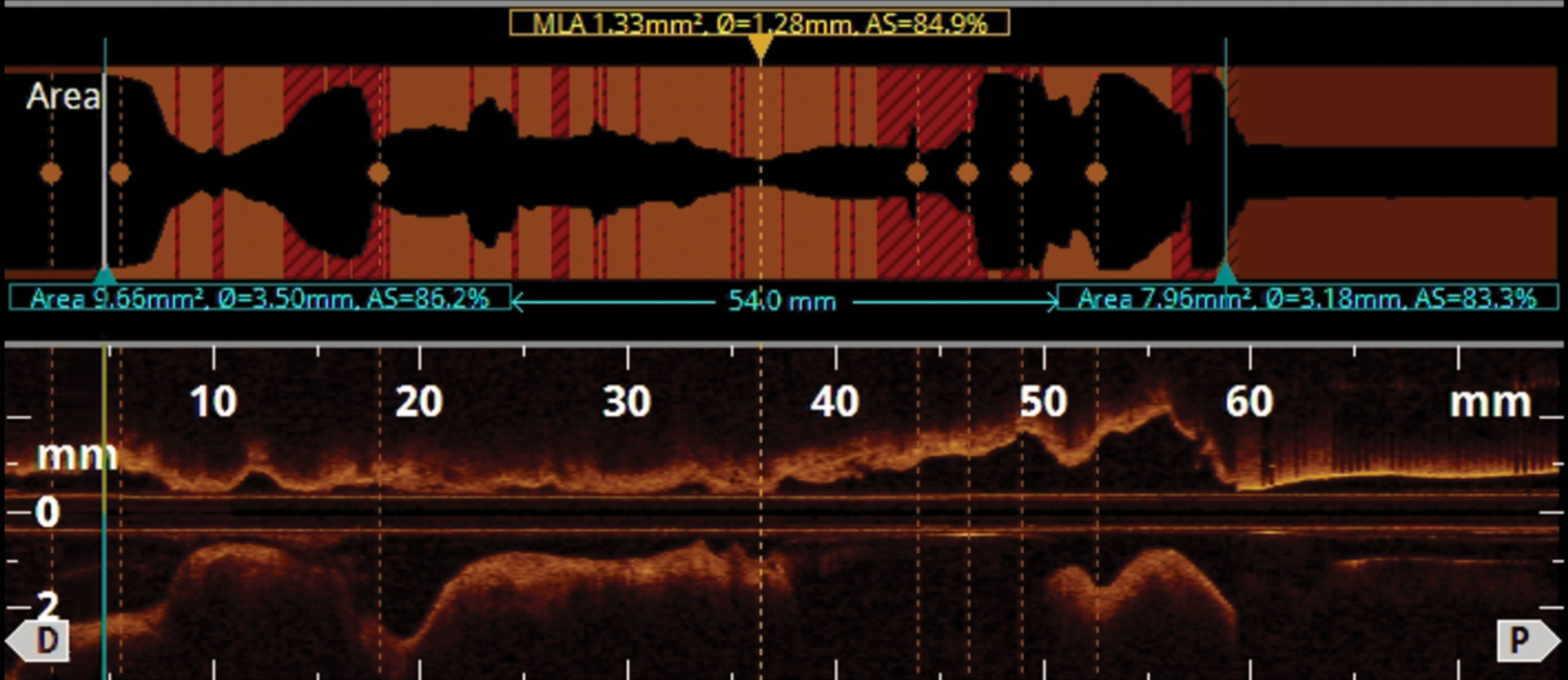 The Role of the Continuous Power Aspiration System in Myocardial ...