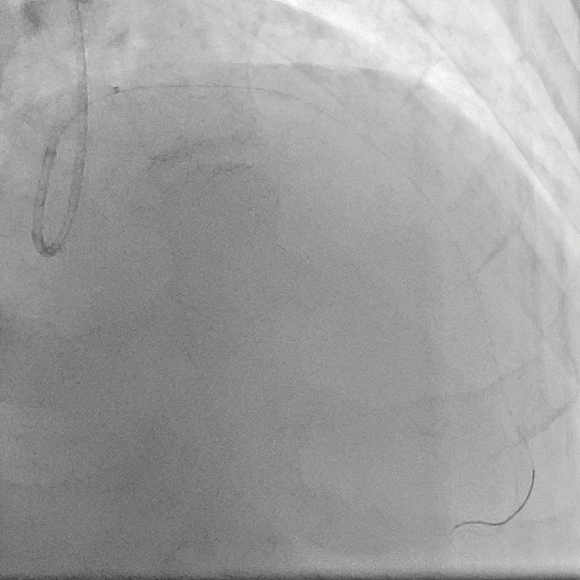 The Role of the Continuous Power Aspiration System in Myocardial ...
