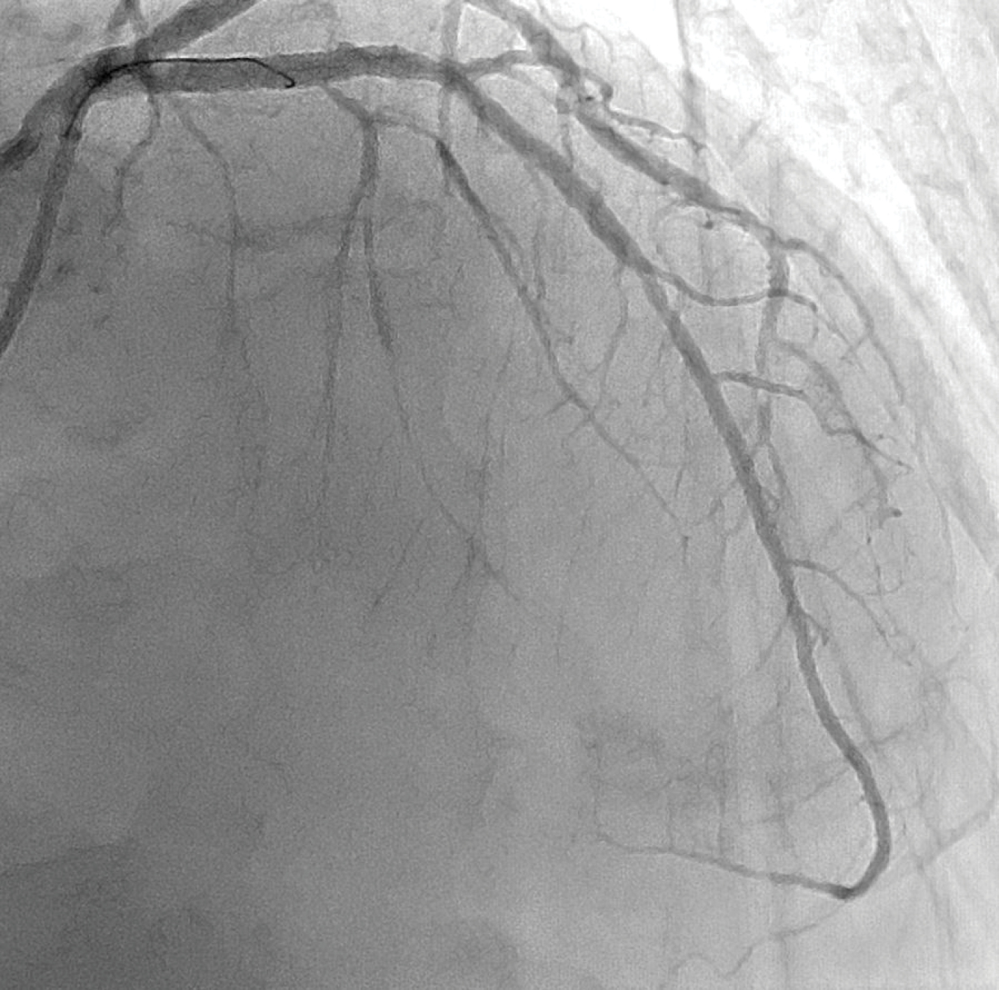 The Role of the Continuous Power Aspiration System in Myocardial ...
