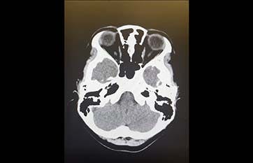 Headache Red Flags - Practical Neurology