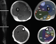 Soleus Muscle Mri