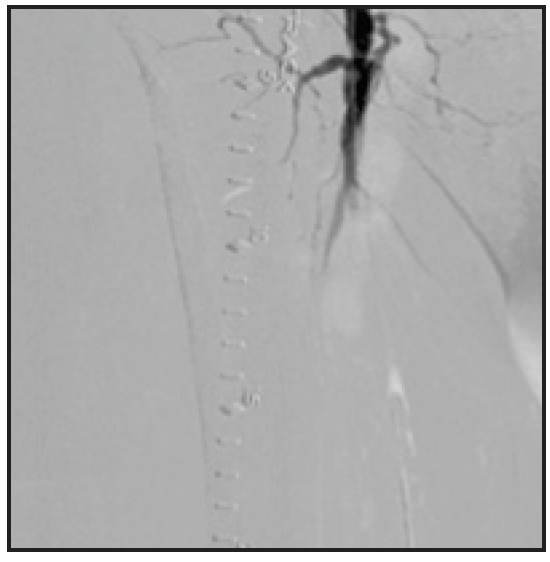 Rethinking Thrombus Removal With the Indigo System: Introducing ...