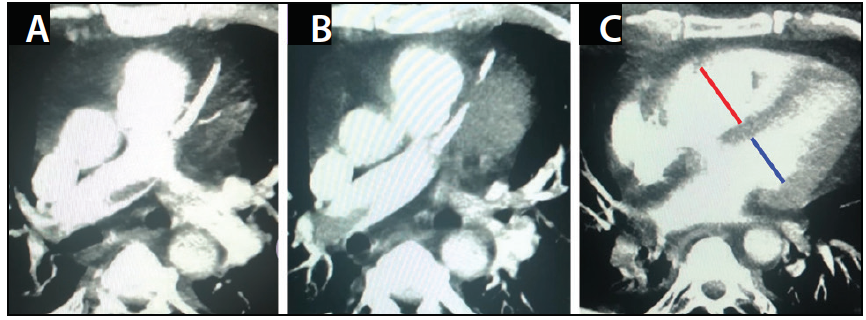 Reversing the Death Spiral: FlowTriever Thrombectomy for High-Risk PE ...