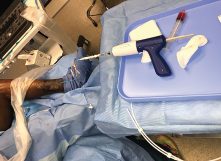 Saphenous Vein Closure Using the VenaSeal™ Closure System to Heal Large ...