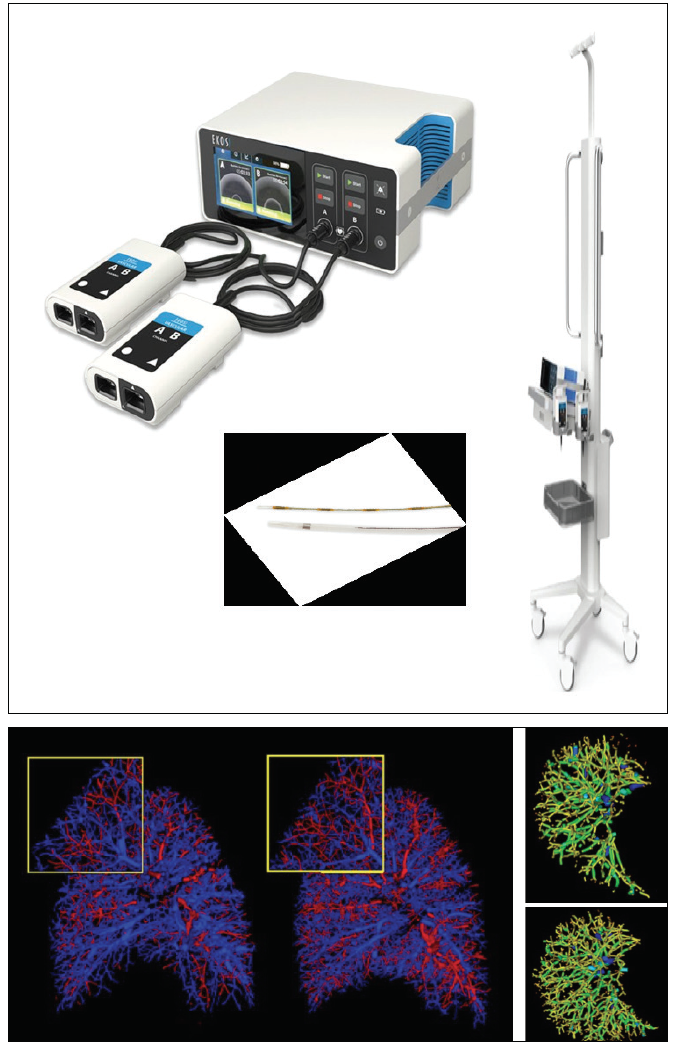 The Search for the Holy Grail of New PE Devices - Endovascular Today