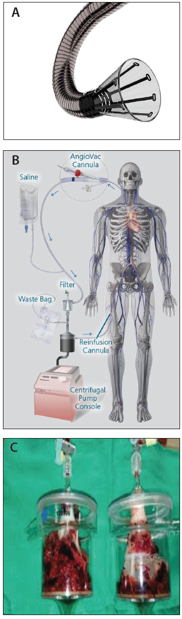 The Search for the Holy Grail of New PE Devices - Endovascular Today