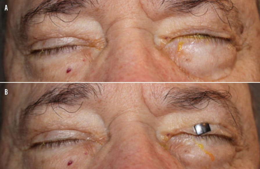 Ulcerative Blepharitis Treatment Blepharitis EyeWiki