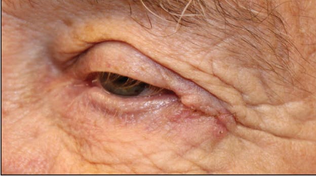 Ulcerative Blepharitis Treatment Blepharitis EyeWiki