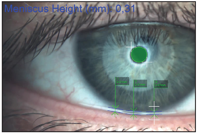 Glaucoma and Ocular Surface Disease: Understanding Visual Quality ...