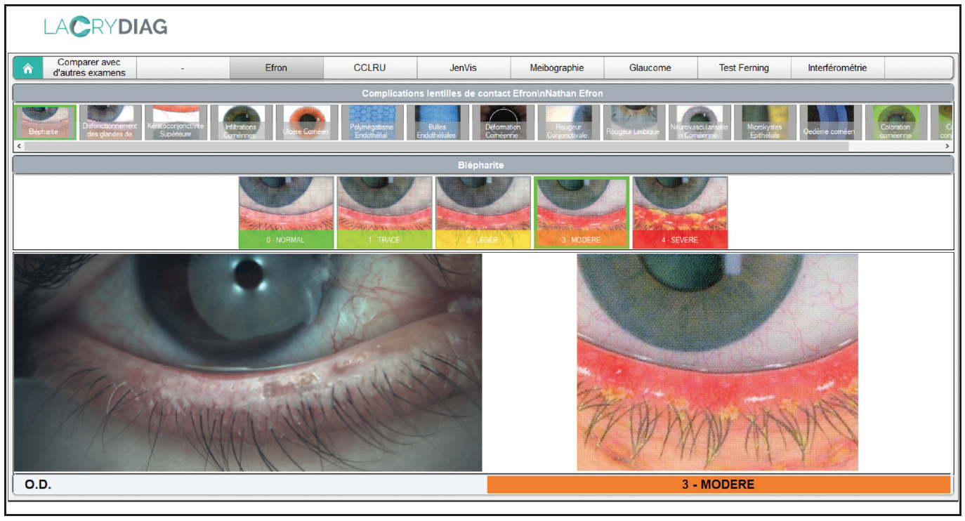 Glaucoma and Ocular Surface Disease: Understanding Visual Quality ...