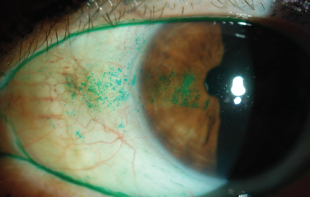 Ocular Diseases That Are More Common in Women - Modern Optometry