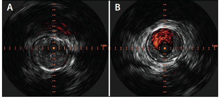 Advancing the Science of Laser Atherectomy for Peripheral Artery ...