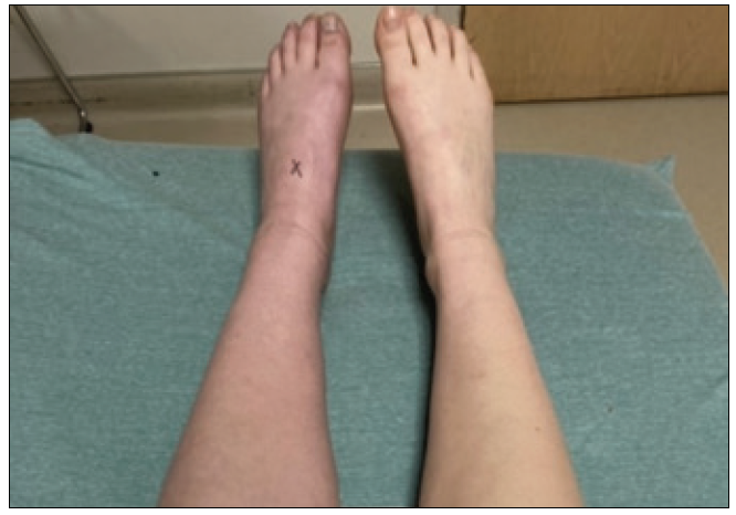 Easing the Burden of VTE Treatment - Endovascular Today