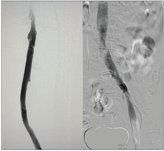 Easing the Burden of VTE Treatment - Endovascular Today