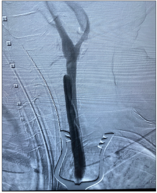 Intraoperative Decision-Making for TCAR Complications - Endovascular Today